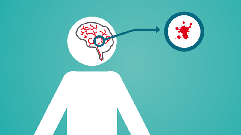 AVC : mieux comprendre pour mieux prévenir